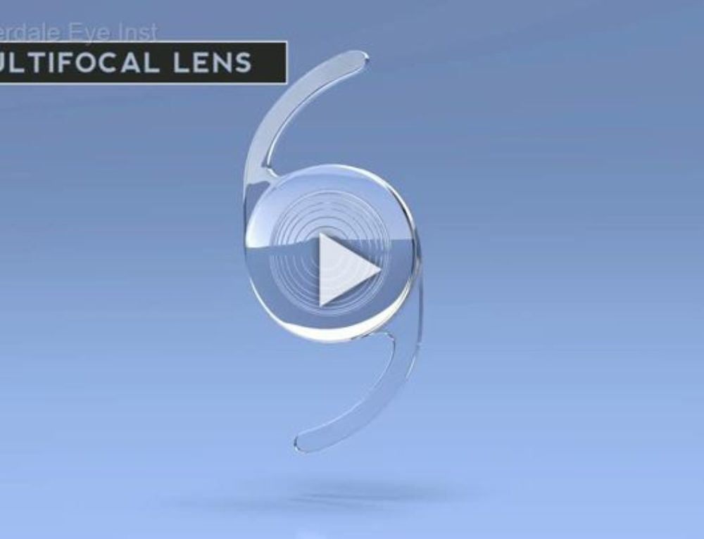 Toric Lens Implant Video | Fort Lauderdale Eye Institiute