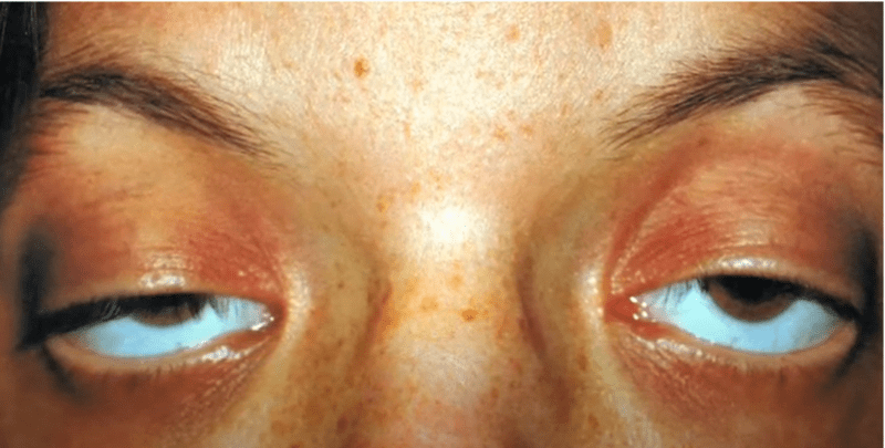 Thyroid Eye Disease Causes And Treatment | Fort Lauderdale Eye Institute