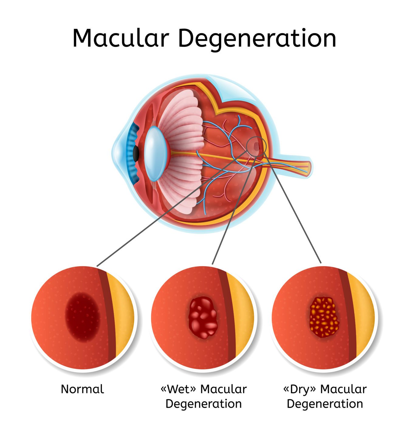 Wet Macular Degeneration Wet AMD Cilnical Trial FLEI