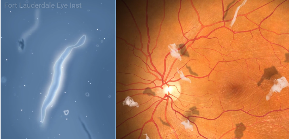 Eye Floaters And Flashes | Fort Lauderdale Eye Institute