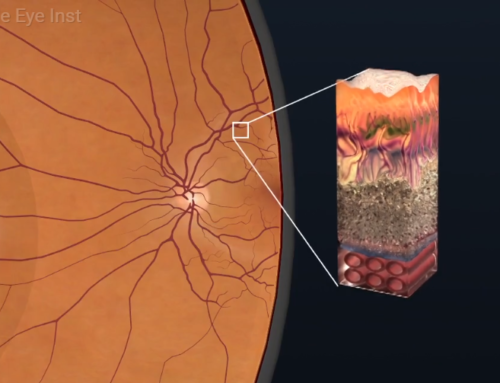 What is Lattice Degeneration? | Fort Lauderdale Eye Institute