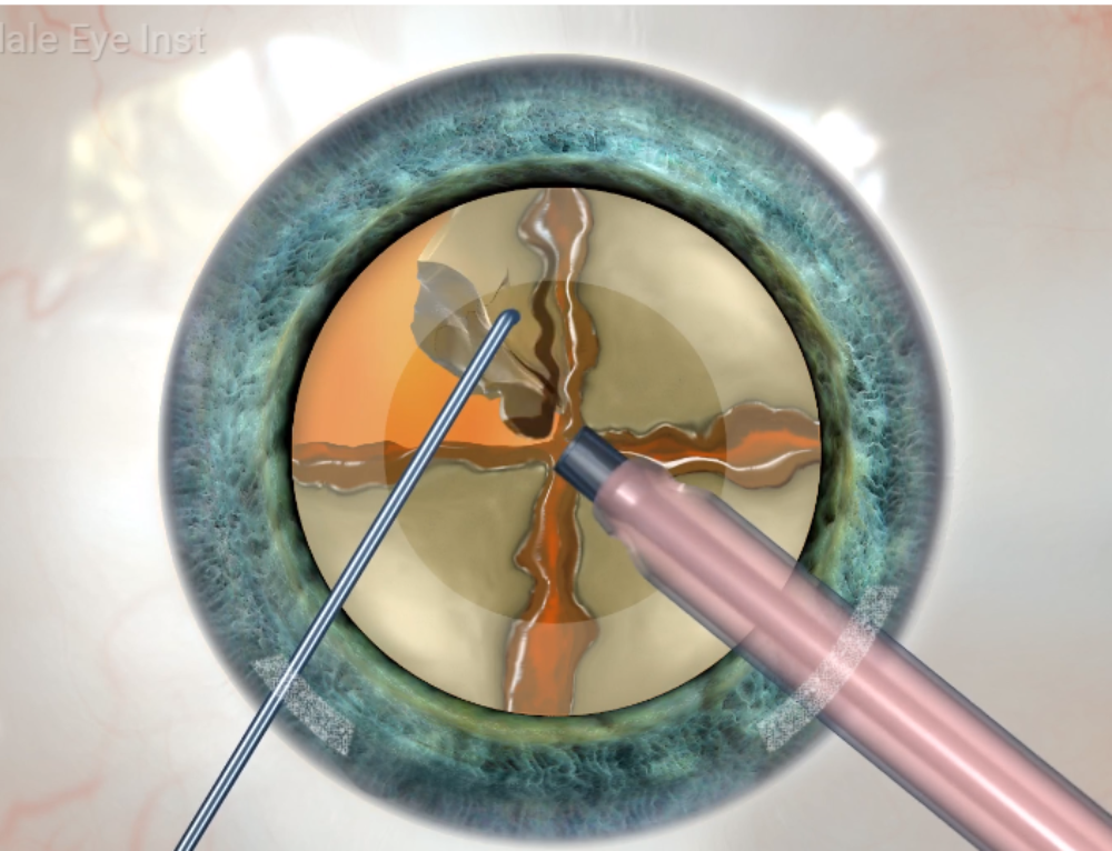 Laser Cataract Surgery vs. Traditional Cataract Surgery - Fort ...