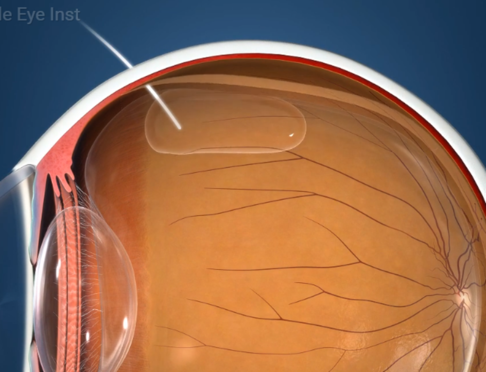 Retinal Detachment Surgery - Fort Lauderdale Eye Institute