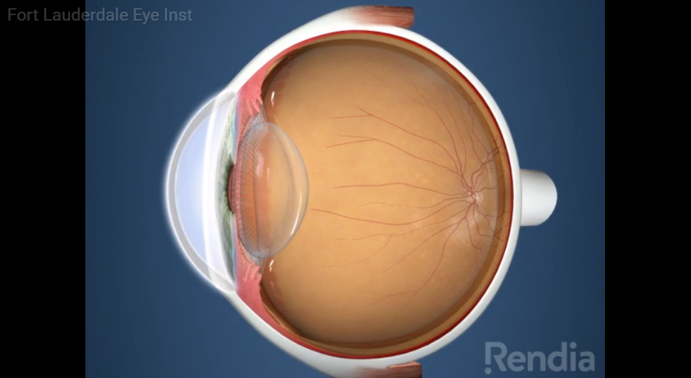 Corneal Erosion | Fort Lauderdale Eye Institute