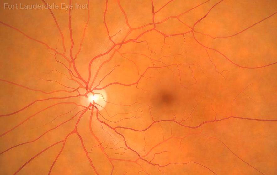 Macular Pucker | Symptoms | Fort Lauderdale Eye Institute