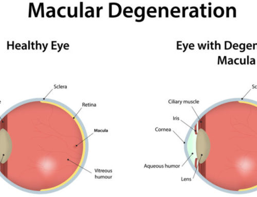 Macular Degeneration Infographic - Fort Lauderdale Eye Institute