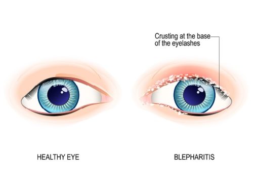 Blepharitis: Symptoms and Treatment | Fort Lauderdale Eye Institute