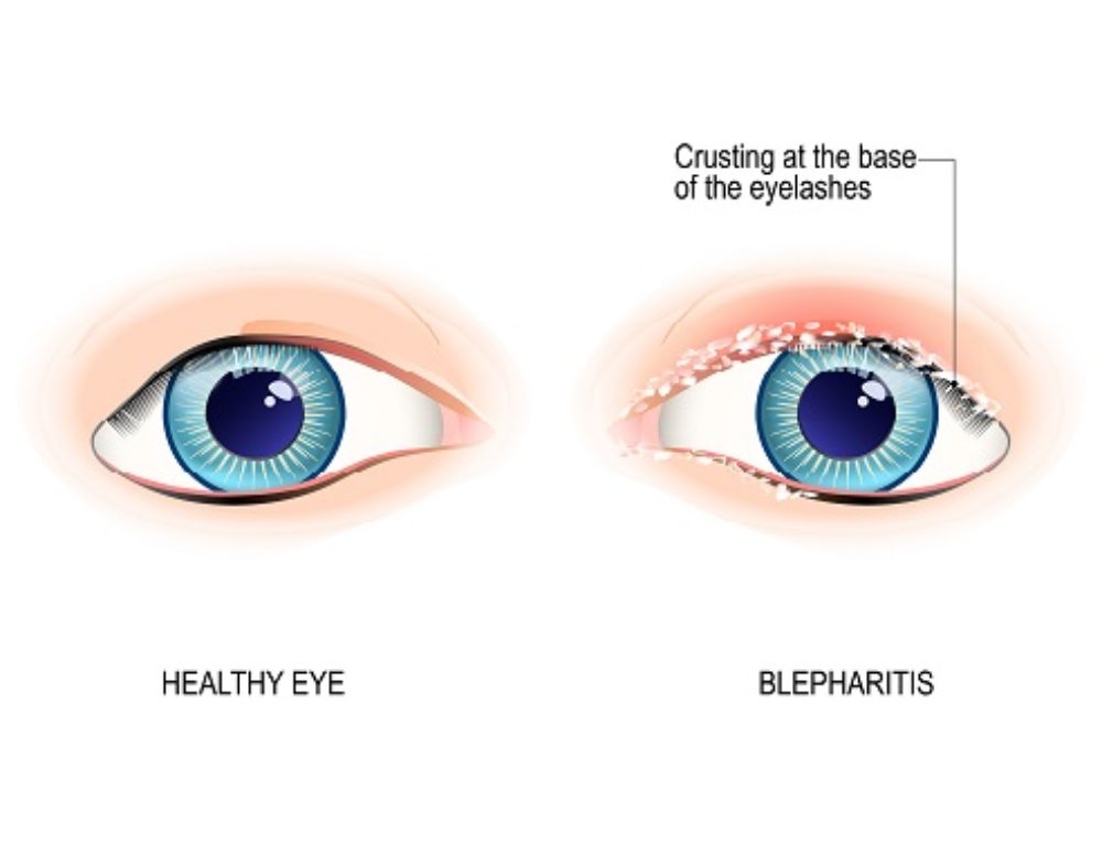 Blepharitis: Symptoms and Treatment | Fort Lauderdale Eye Institute