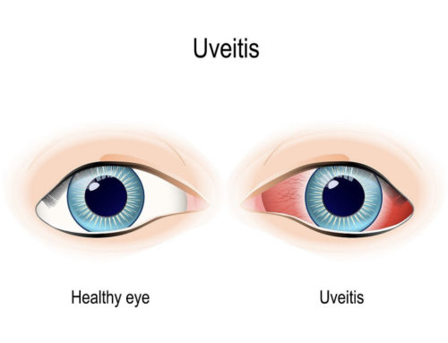 Corneal Abrasion vs Laceration | Fort Lauderdale Eye Institute