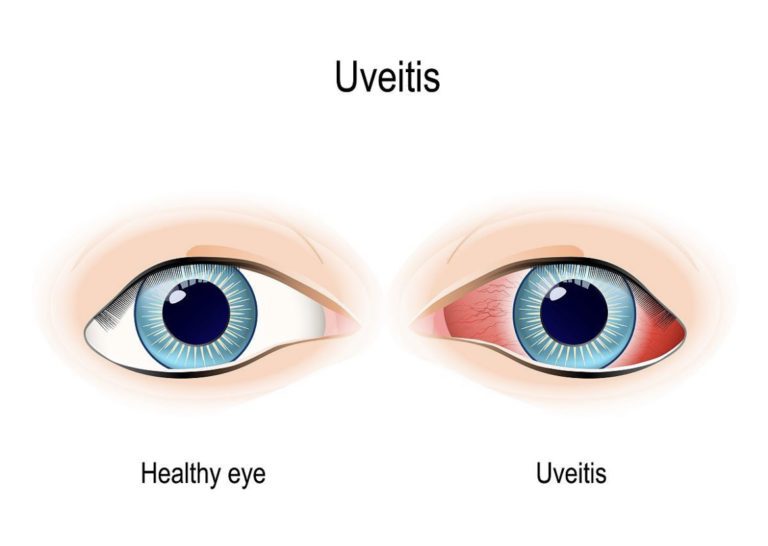 Uveitis Overview | Fort Lauderdale Eye Institute