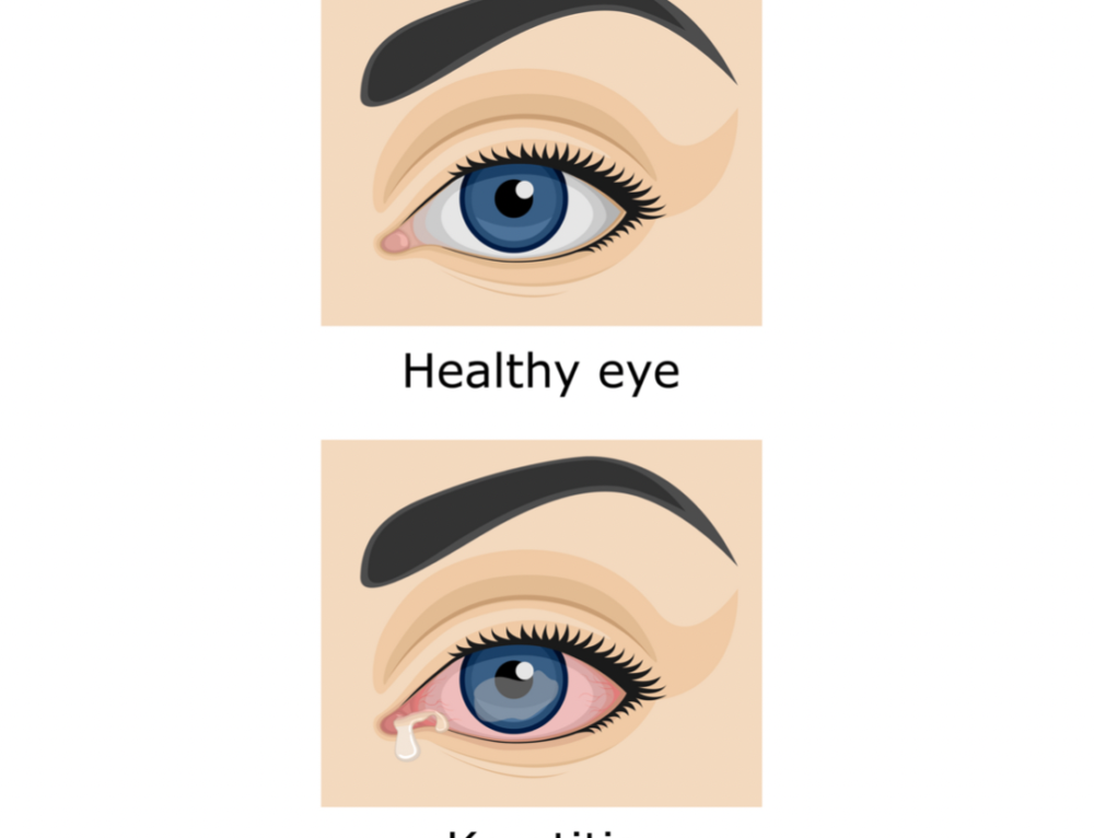 Corneal Abrasion vs Laceration | Fort Lauderdale Eye Institute