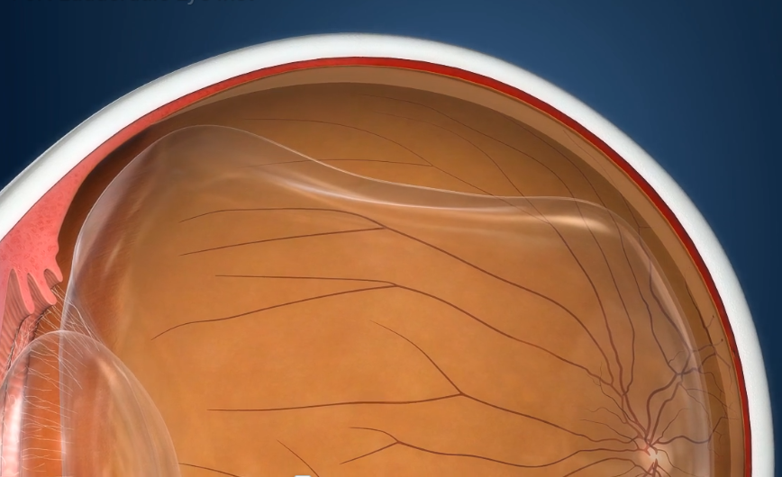 What Is A Macular Pucker? | Fort Lauderdale Eye Institute