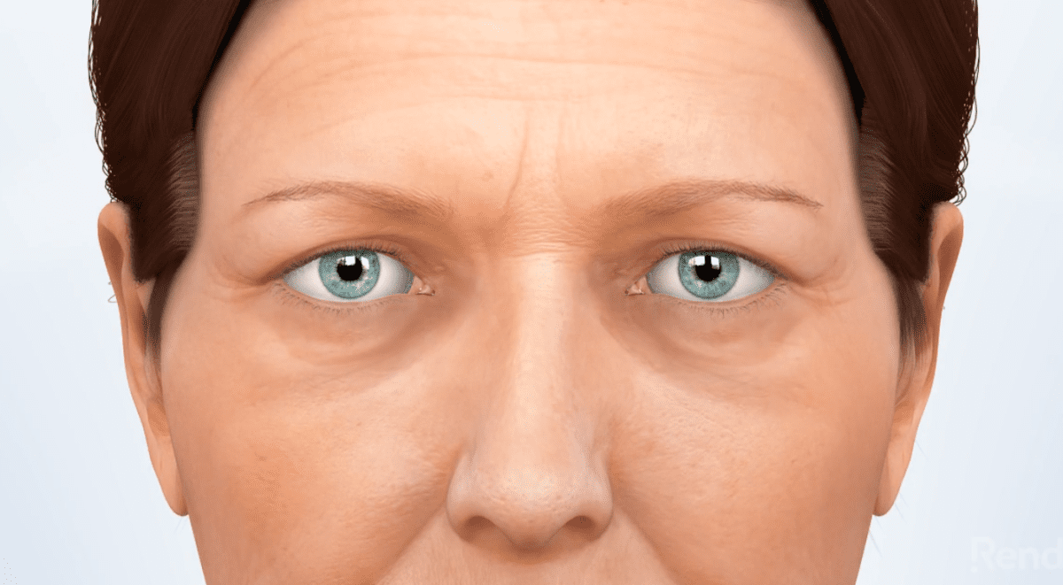 Understanding Upper Lid Blepharoplasty For Better Vision
