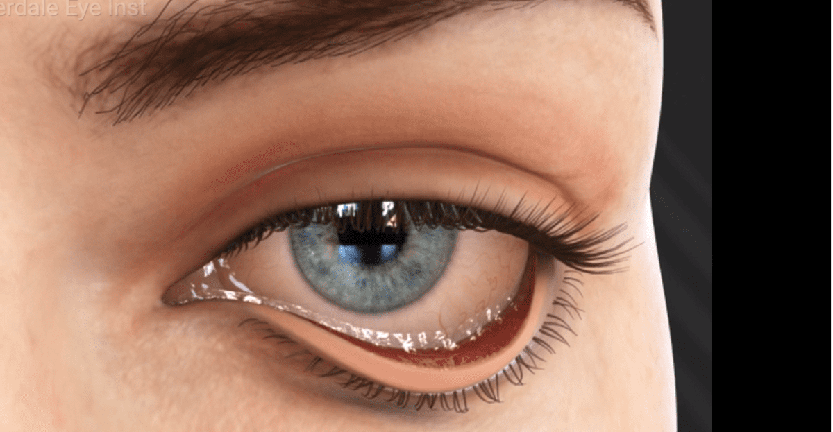 Ectropion And Entropion Overview | Fort Lauderdale Eye Institute