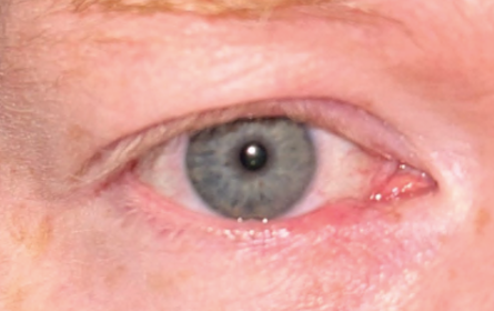 Skin Cancer And Eyelid Reconstruction | Fort Lauderdale Eye Institute