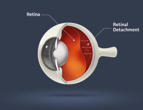 Retinal Detachment Surgery - Fort Lauderdale Eye Institute