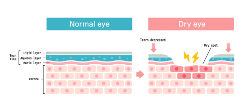 Dry Eyes: Causes And Treatments | Fort Lauderdale Eye Institute