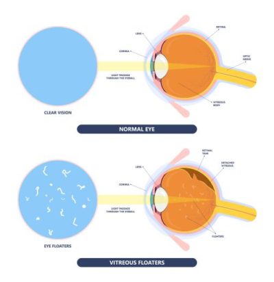 Understanding Flashes And Floaters | Fort Lauderdale Eye Institute