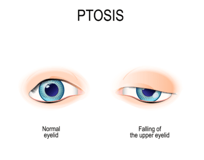 Understanding Ptosis Causes And Effective Treatments