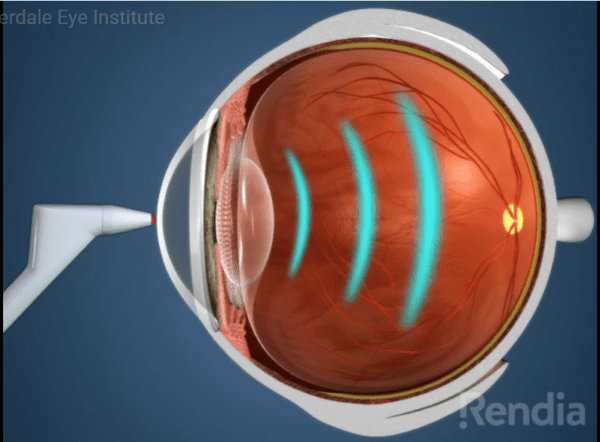 Cataract Treatment Video | Fort Lauderdale Eye Institute