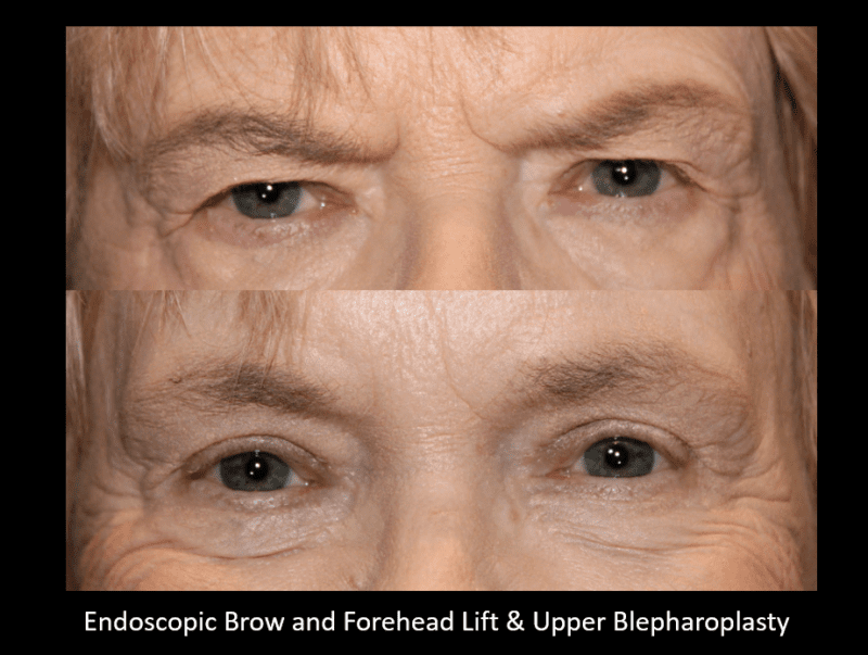Oculoplastics Surgery: Before And After Insights