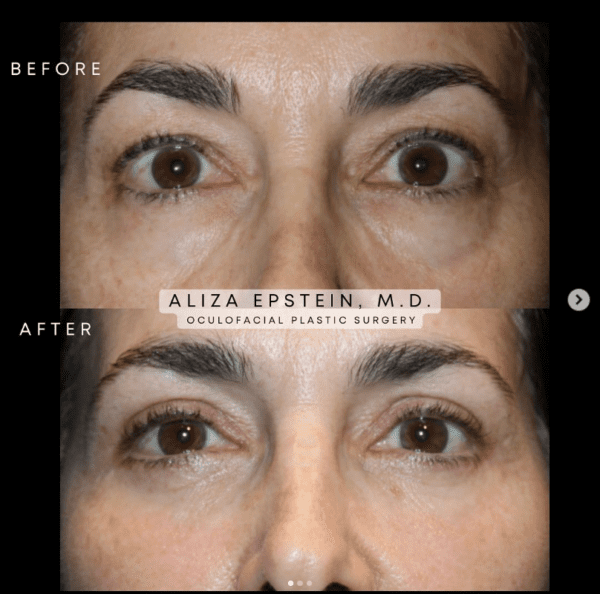 CO2 Laser For Under Eyes | Fort Lauderdale Eye Institute