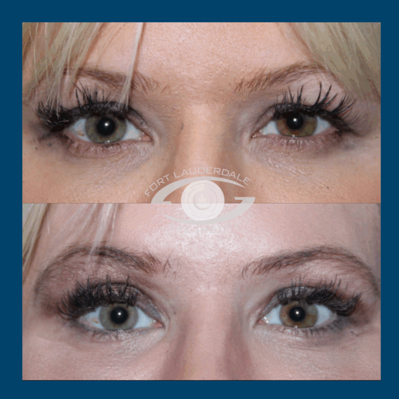 Upper Blepharoplasty | Fort Lauderdale Eye Institute