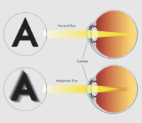 Understanding Astigmatism: Causes, Symptoms, And Treatment | Fort ...